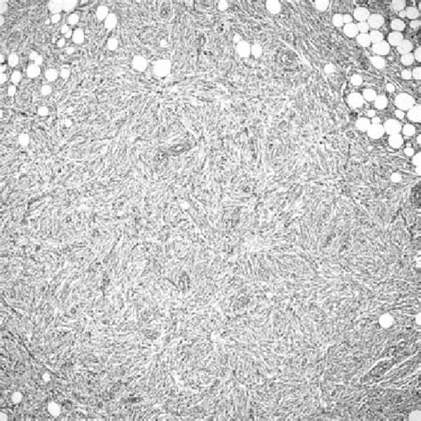 Photomicrograph Of The Lesion Composed Of Fusiform Cells With A