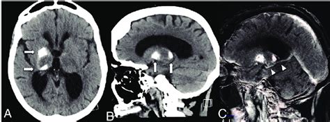 Noncontrast Ct Of The Head A And B Shows Dystrophic Calcification Of Download Scientific