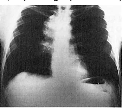 Figure 1 From Voluminose Masse Retroperitoneali E Toraciche A Tipo Di