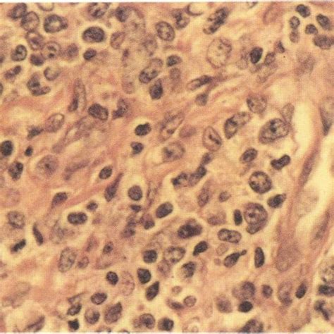 Higher Magnification Showing Centrocytic Centroblastic Cells