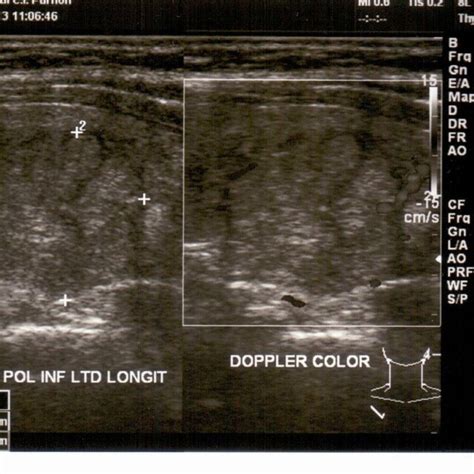 Thyroid Ultrasound Aspect Of Diffuse Goiter Download Scientific Diagram