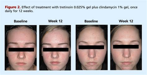 Topical Tretinoin Benefits At Herman Dunlap Blog