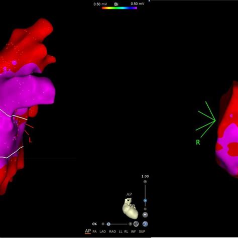 Electroanatomical Mapping Eam 3d Models Of The Left Atrium Before