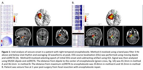 Eeg Source Localization Of Temporal Encephaloceles