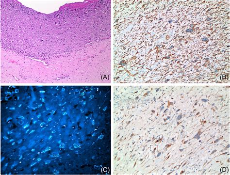 A Hematoxylin‐eosin Stained Spindle Shaped And Pleomorphic Neoplastic
