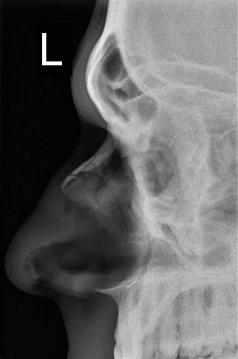 Xray Pictures Of Broken Nose Xray Pictures