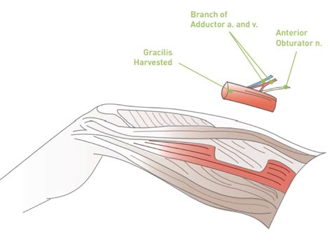 Gracilis Muscle Flap Free Gracilis Muscle Transfer For Facial Paralysis