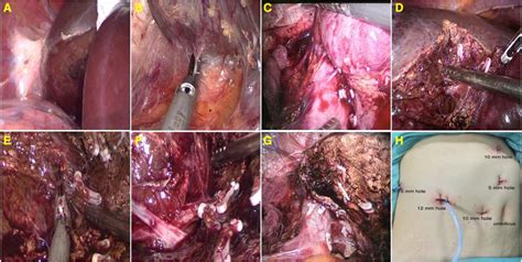 Expose And Detach The Right Triangular Ligament A Detach The Livers