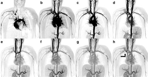 First Pass And Steady State Mr Angiographic Imaging Of The Systemic