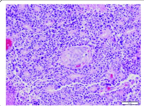 Microphotograph Of Pancreatoblastoma Showing Characteristic Squamoid Nests Download Scientific