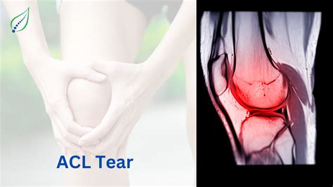 Non Surgical Acl Tear Treatment Effective Solutions For Recovery