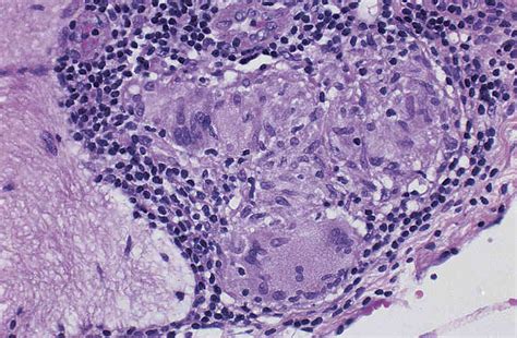 盲腸にできる潰瘍；腸結核とは 横浜で大腸内視鏡による大腸検査なら、ららぽーと横浜クリニック