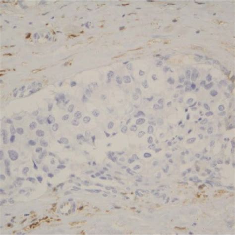 Invasive Ductal Carcinomas With Negative A And Positive B Aldh1