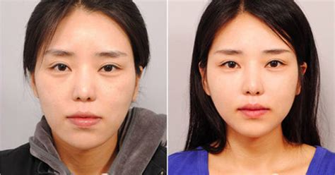 연예인 그들이 공개한 양악수술 위험한 거 아니야