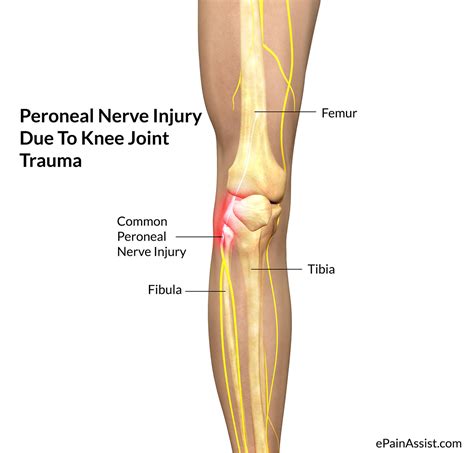 Peroneal Nerve Fibular Nerve