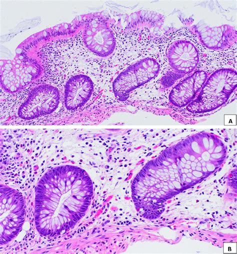 Mycophenolate Associated Colitis In An Orthotopic Heart Transplant Patient An Unusual Case