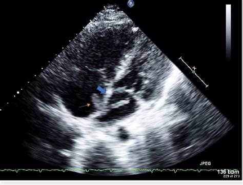 Two Dimensional Transthoracic Echocardiogram With Color Flow And