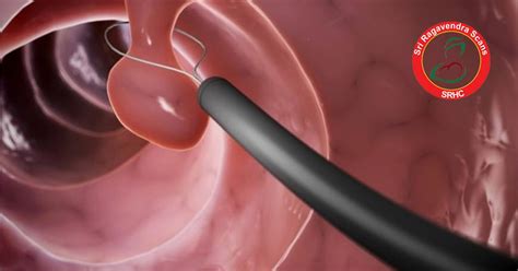 Colonoscopy Colonoscopy Hospital Colonoscopy Procedurecolonoscopy