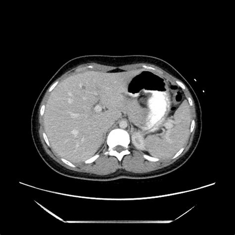 Filecrohns Disease Terminal Ileitis Fistulizing Radiopaedia 98245