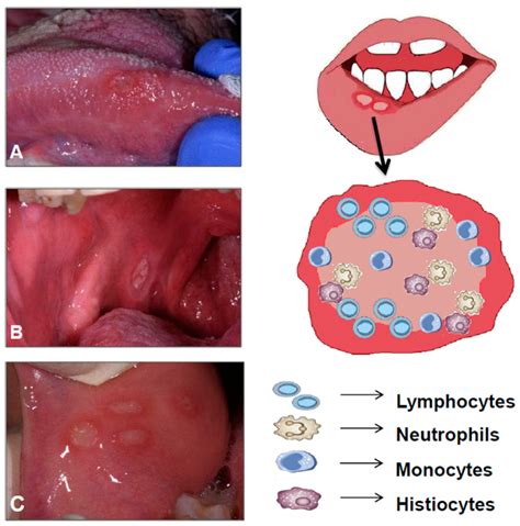 Aphthous Ulcers Crohns