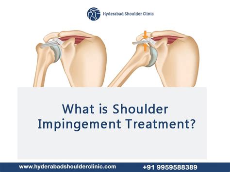 Shoulder Impingement Syndrome Causes Symptoms 54 Off
