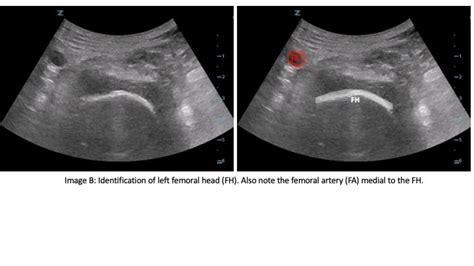 Pericapsular Nerve Group Peng Block For Patients With Hip Or Pelvis Fractures In The Ed Em