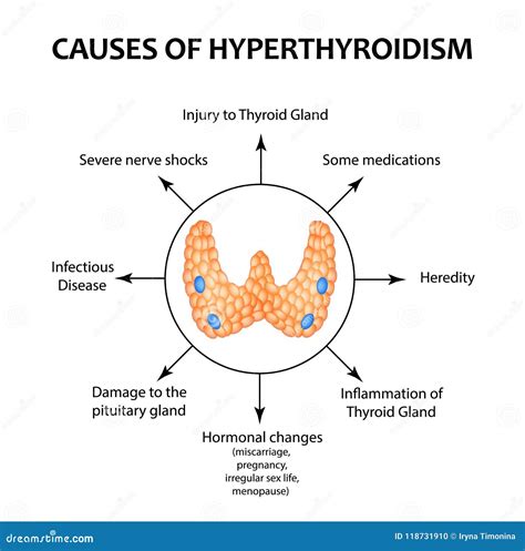 The Causes Of Hyperthyroidism Of The Thyroid Gland Infographics