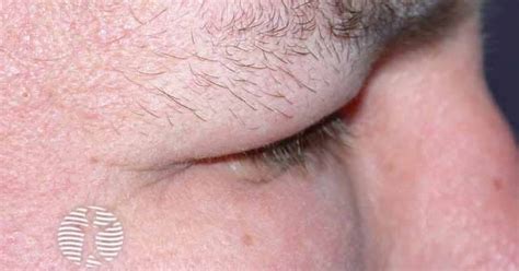 Dermnet® Plant Dermatitis Image