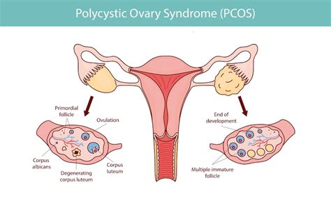 Premium Vector Polycystic Ovary Syndrome Pcos Ovarian Cysts Of The