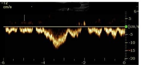 Module 4 Colour And Spectral Doppler Protocol Cfv To Popliteal Vein