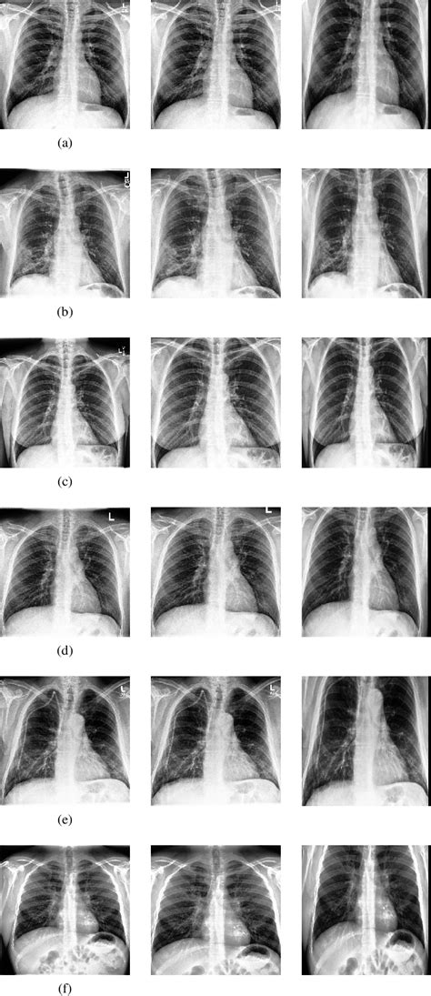 Figure 4 From Attention Driven Spatial Transformer Network For Abnormality Detection In Chest X