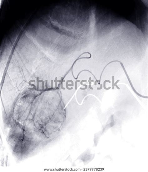 Transarterial Chemoembolization Tace Medical Procedure Used Stock
