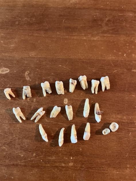 All Of My Extracted Teeth… R Teethporn