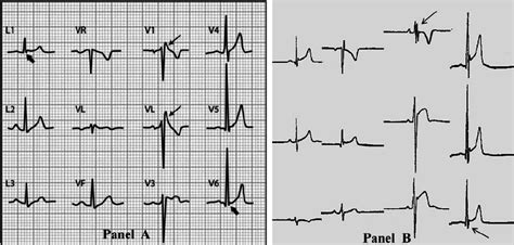A Brugada Ecg Pattern Mimicking Irbbb The ‘ J Wave Arrows Of Download Scientific Diagram