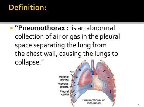 Pneumothorax 1pptx Definition Types Clinical Features Diagnosis