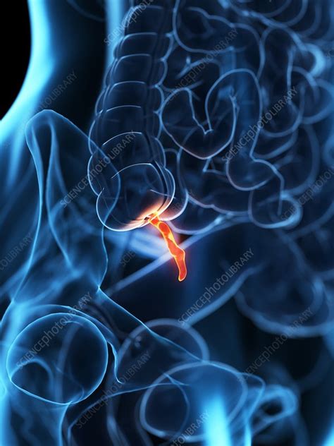 Inflamed Appendix Conceptual Illustration Stock Image F027 1483 Science Photo Library