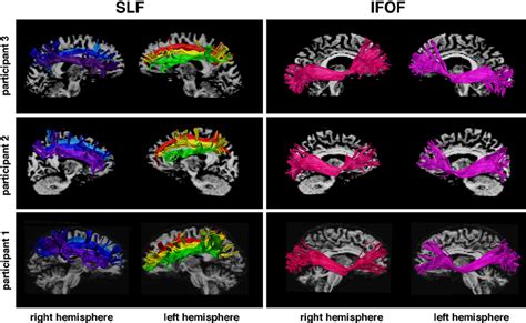 Examples Of Spherical Deconvolution Tractography Reconstruction Of The