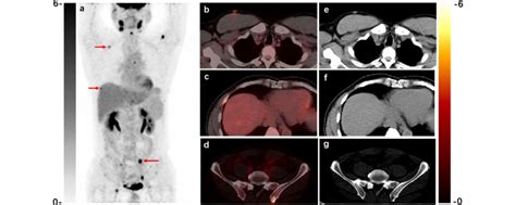 A Typical Rdd Case With Multisystem Lesions Revealed By 18 F Fdg