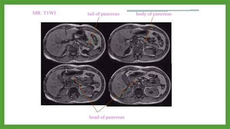 Pancreatic Anomaly Radiologypptx