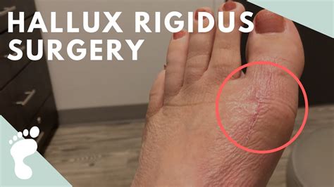 Hallux Rigidus Operation Causes Orthopedic Medical