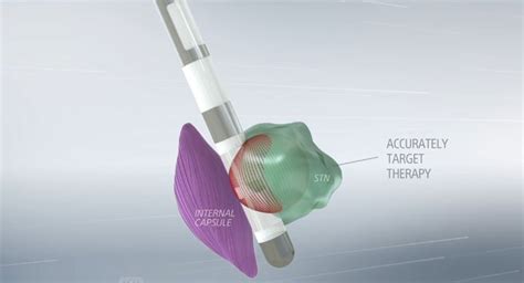 What Are The Recent Advances In DBS Surgeries