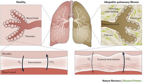 Interstitial Lung Disease Classification