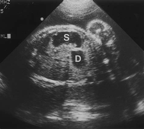 The Double Bubble Sign Radiology