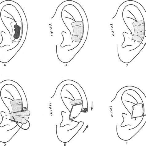 Pdf Reconstruction Of Non Marginal Ear Defect By A Postauricular
