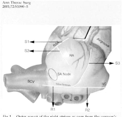 Figure 1 From Surgical Treatment Of Atrial Fibrillation Using
