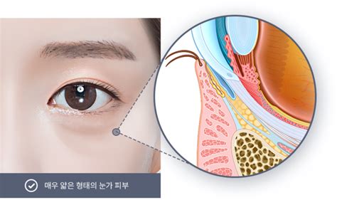 눈밑꺼짐리프팅 유앤미클리닉