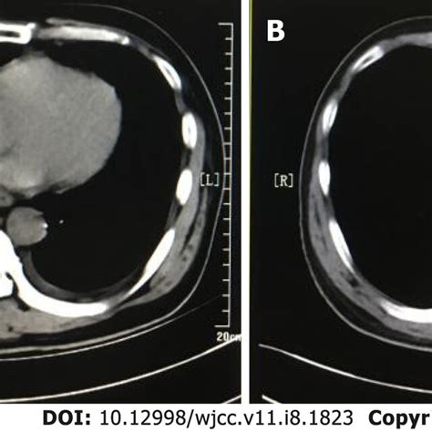 Patients Chest Computed Tomography On Admission And At Discharge A