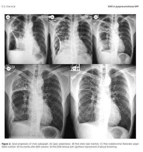 Chest Radiograph In Pyopneumothorax Patients With Pneumonia Sze Shyang Kho Posted On The Topic