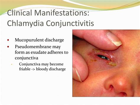 Ppt Chlamydia In The Newborn Powerpoint Presentation Free Download