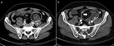 Sigmoid Mesocolon Related Hernia In A 80 Year Old Man With Acute Download Scientific Diagram